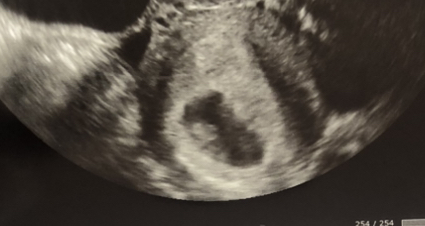 【6w5d】CRL3mmで小さめ？胎嚢に白いモヤモヤ。心拍確認もできなくて切迫流産→無事に心拍確認