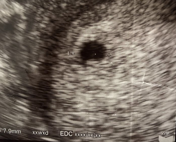 【6w5d】CRL3mmで小さめ？胎嚢に白いモヤモヤ。心拍確認もできなくて切迫流産→無事に心拍確認