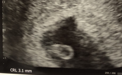 【6w5d】CRL3mmで小さめ？胎嚢に白いモヤモヤ。心拍確認もできなくて切迫流産→無事に心拍確認